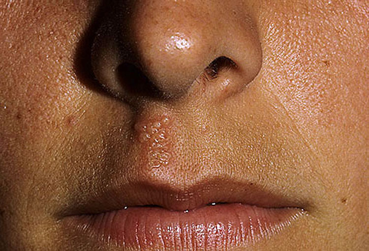 Herpes labial: Tratamiento, prevención y TODO lo que usted necesita saber - Conocer Salud