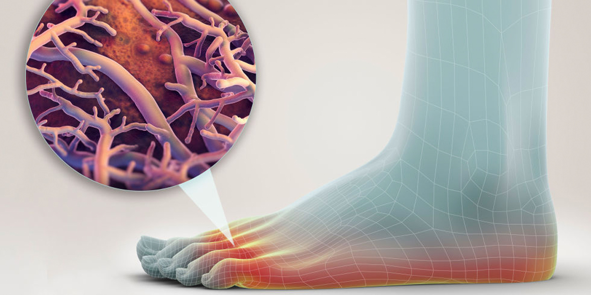 Lo que debe saber sobre las infecciones por hongos - Prevención y ...