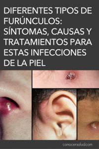 Diferentes tipos de furúnculos: síntomas, causas y tratamientos para ...