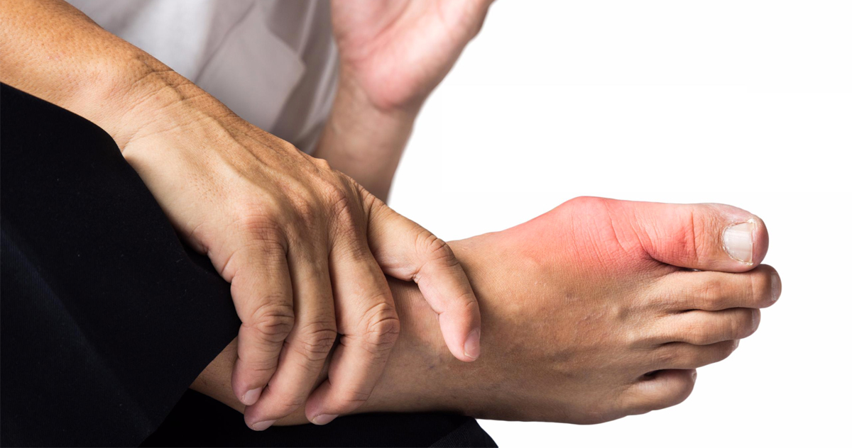 Gota: causas, síntomas y tratamientos - Conocer Salud