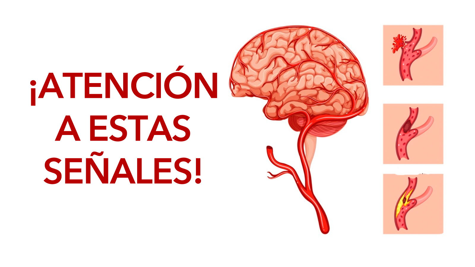 5 Síntomas De Derrame Cerebral Que La Gente Ignora