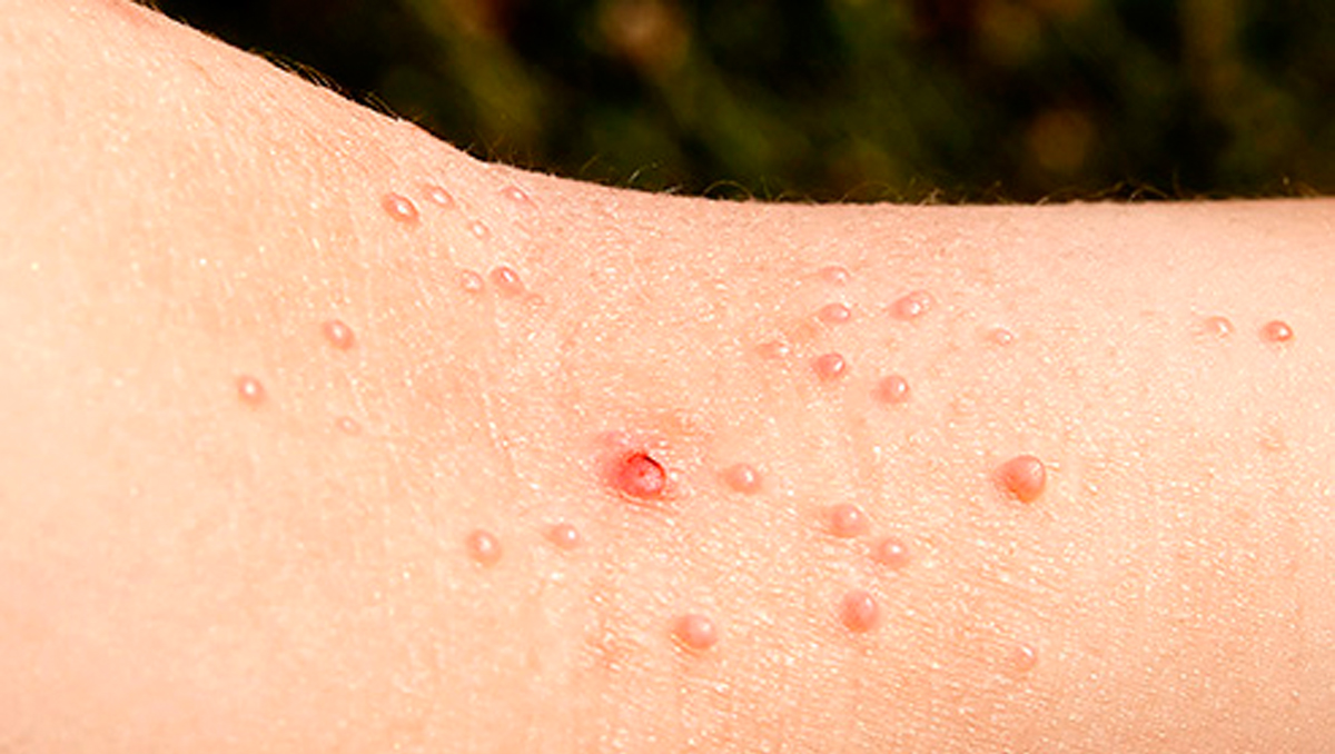 7 remedios caseros simples para deshacerse de las verrugas naturalmente ...