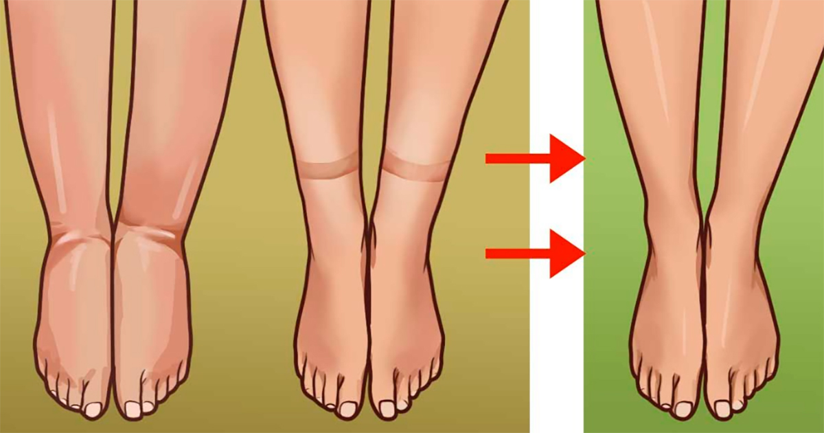 Retención de líquidos (edema): principales causas y cómo solucionarlo ...